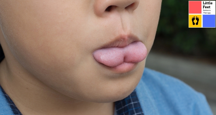 The Relationship Between Tongue Ties, Feeding Difficulty, and Torticollis | Little Feet Therapy ...
